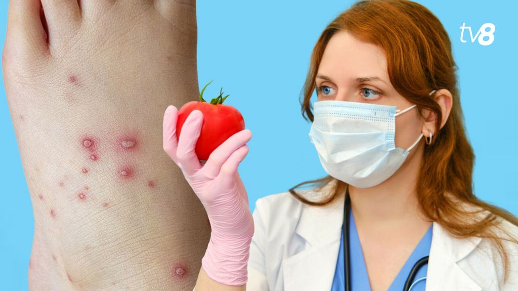 TV8.md - Un nou virus atacă copiii: Ce este „Gripa tomatelor ...